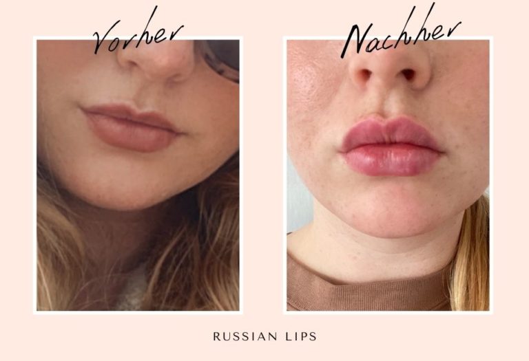 Russian Lips: Alles zur Lippenunterspritzung & Erfahrungen